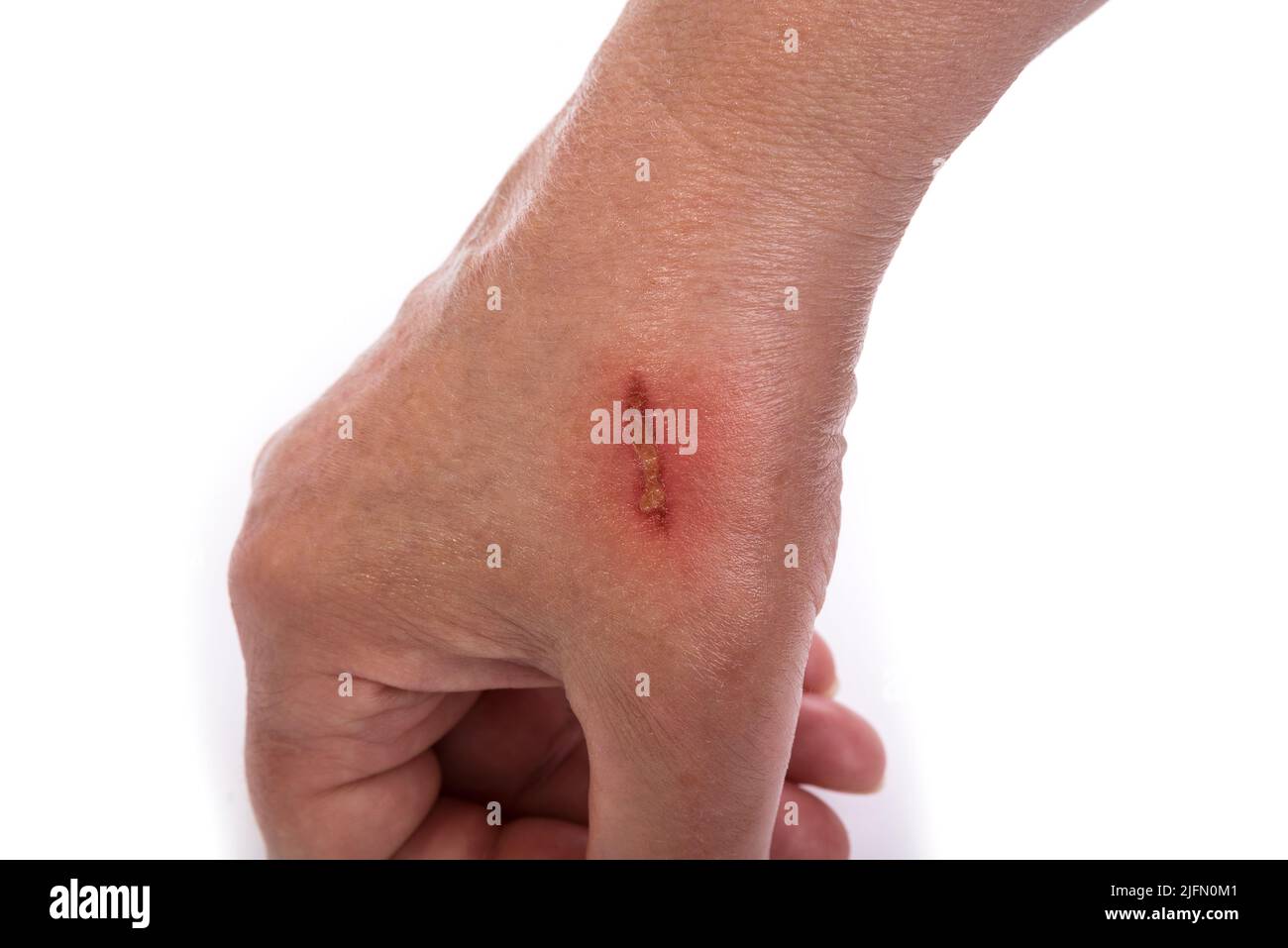 Burn on female hand from a cooking pot on a white Stock Photo - Alamy