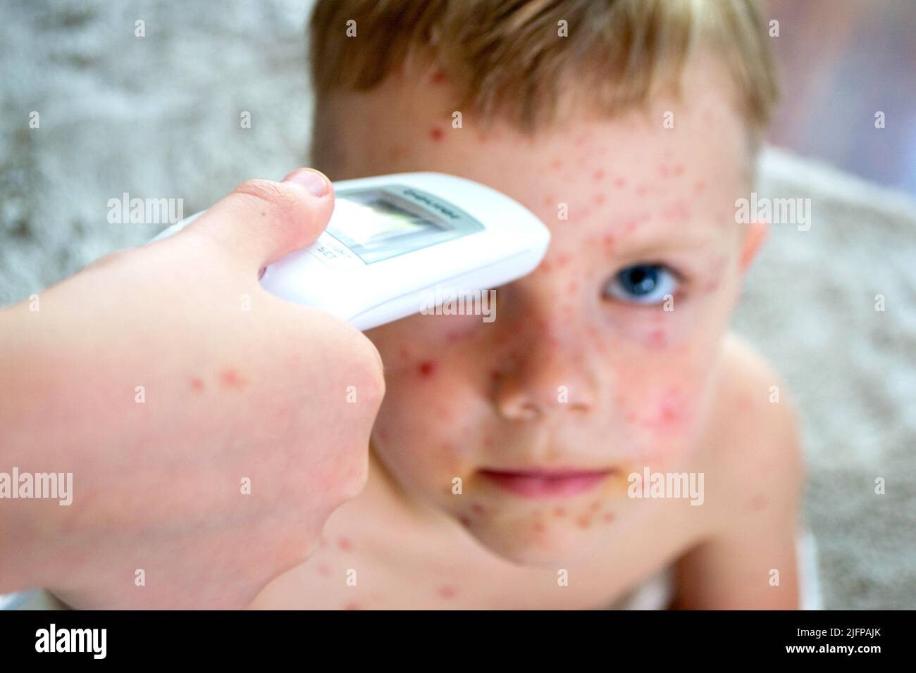 Smallpox vaccination boys hi-res stock photography and images - Alamy