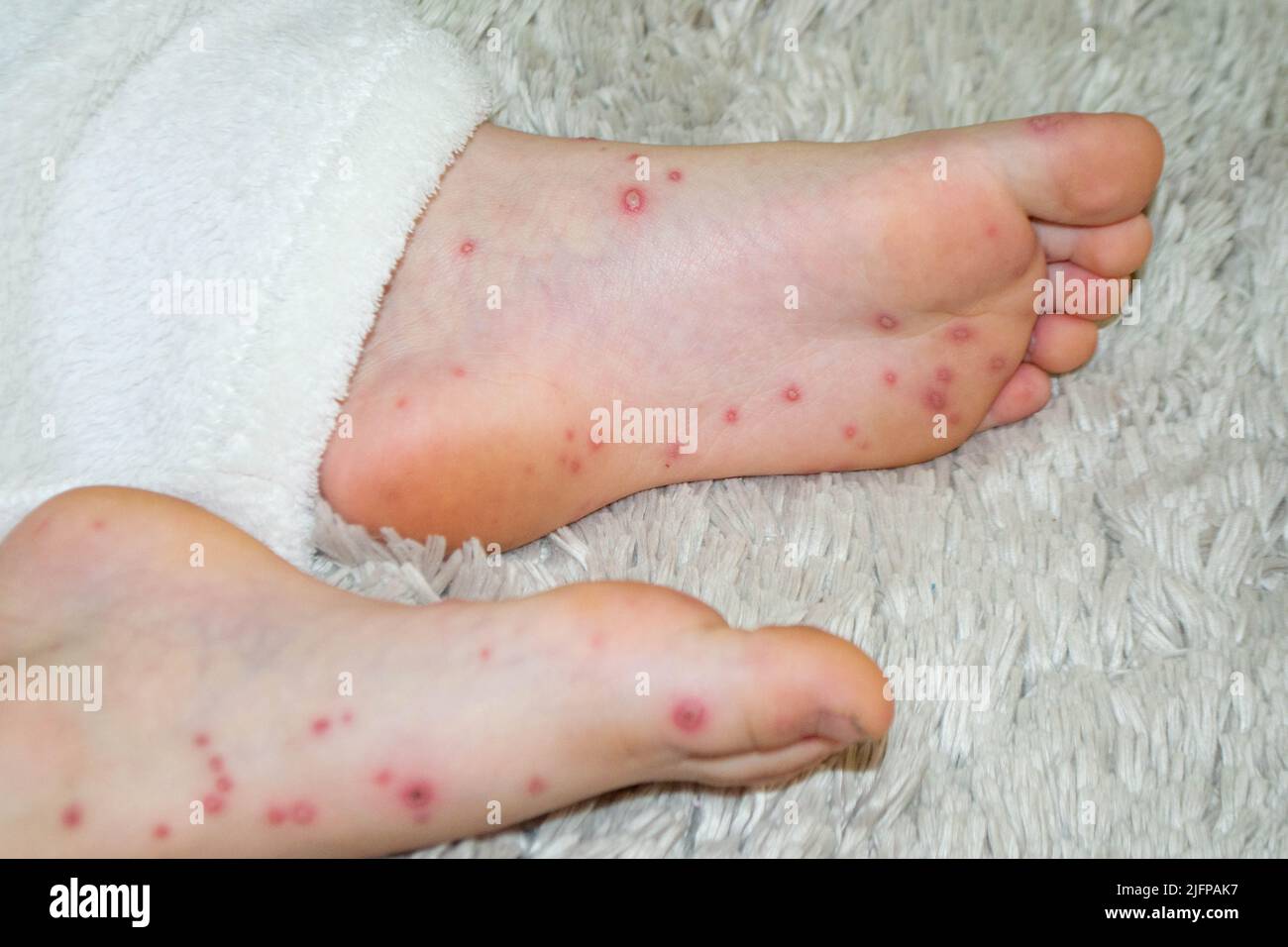 Natural vaccination. Contagious disease Stock Photo - Alamy