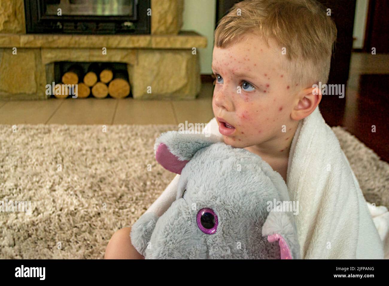 Smallpox vaccination boys hi-res stock photography and images - Alamy