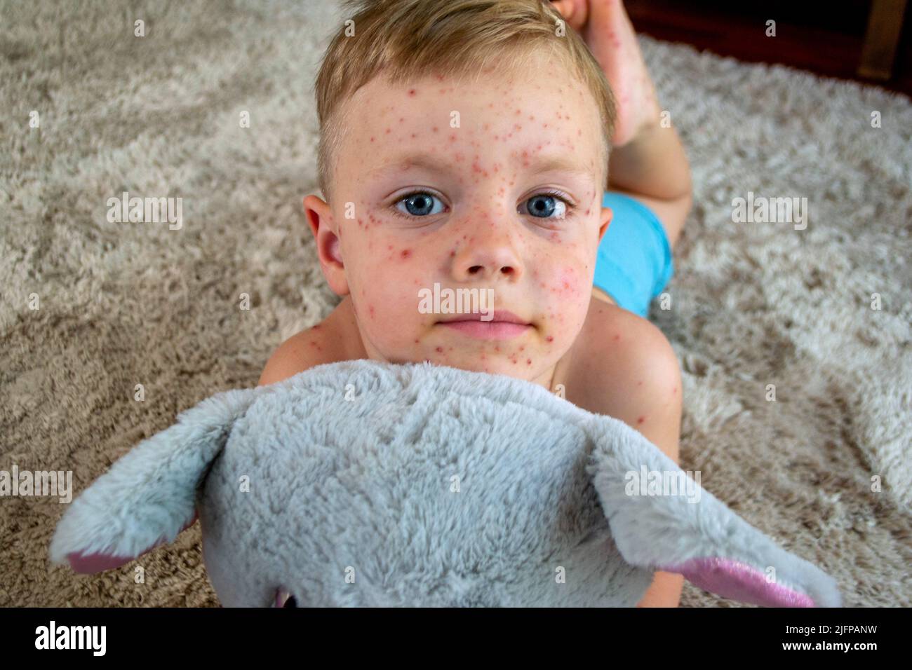 Smallpox vaccination boys hi-res stock photography and images - Alamy