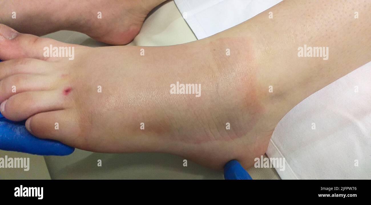 Swollen skin with a red outline after a insect bite. Red spots on the ...