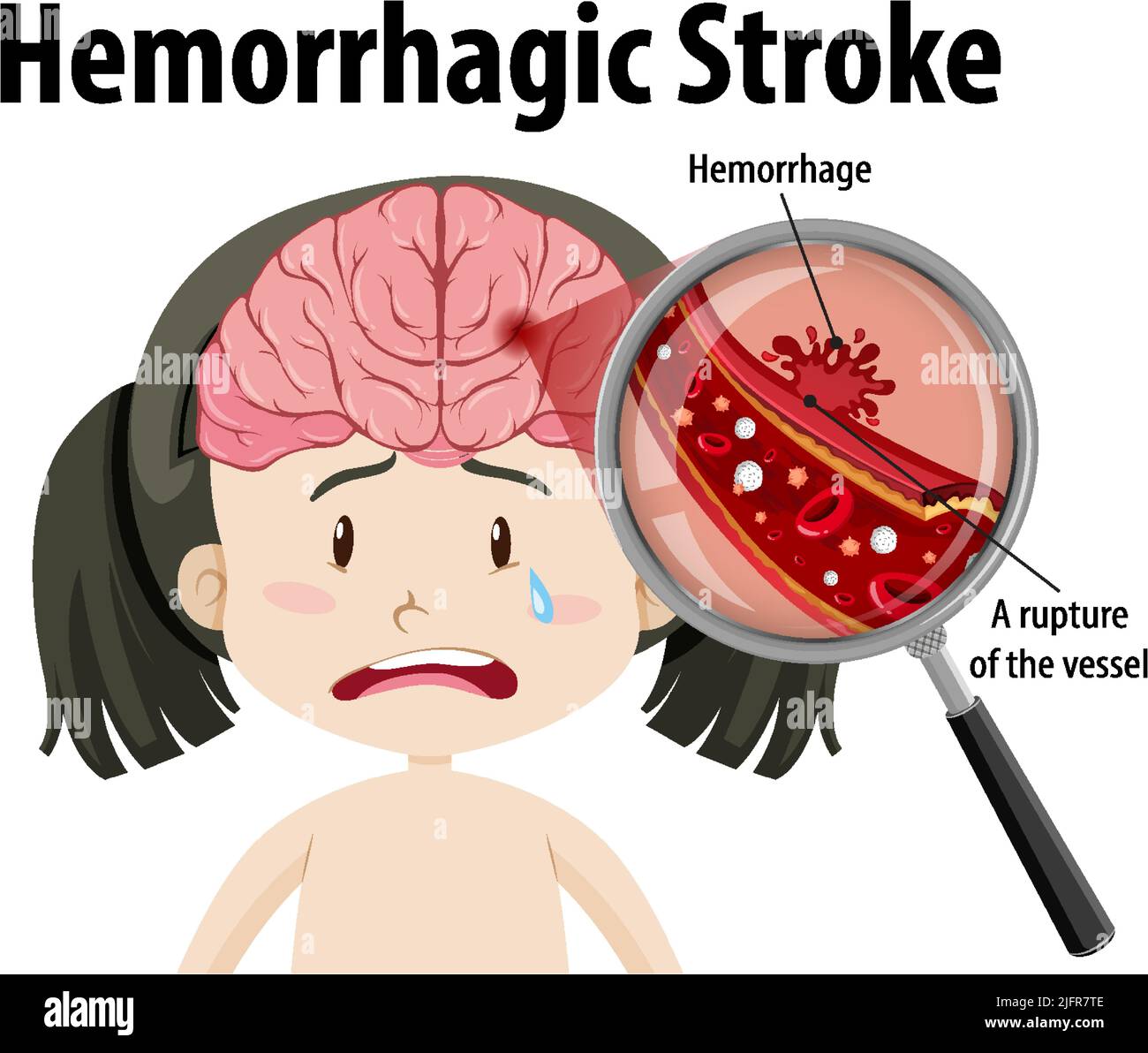 Girl with Hemorrhagic stroke illustration Stock Vector Image & Art - Alamy