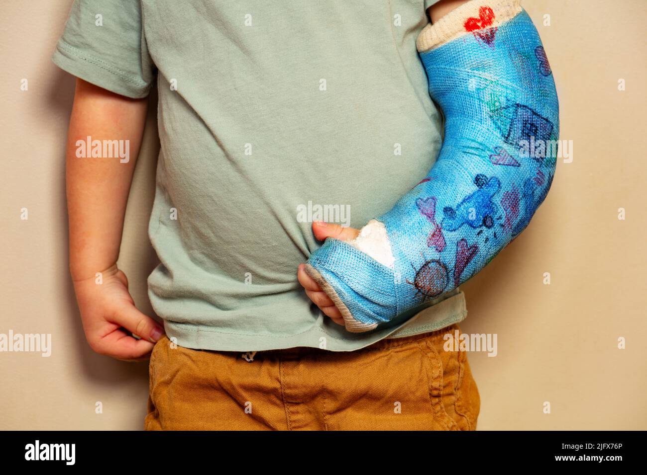 Close-up of a child broken hand in plaster cast with drawings Stock ...