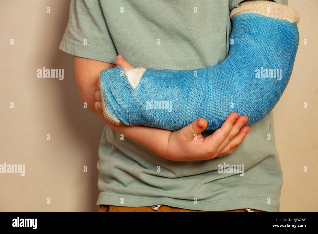 Close-up of a broken hand blue plaster cast after accident Stock Photo ...