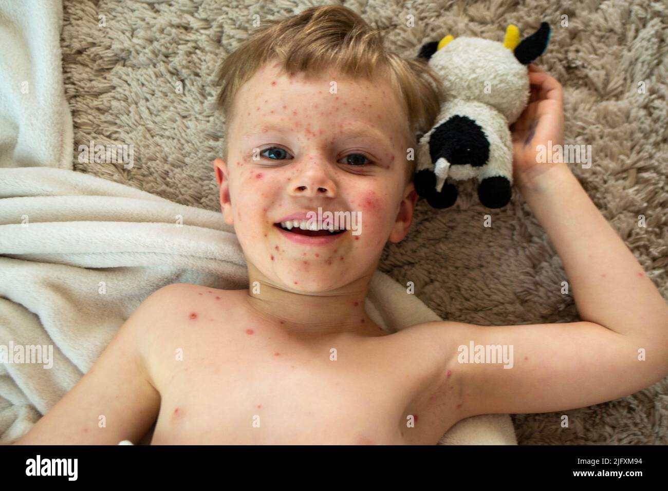 Smallpox vaccination boys hi-res stock photography and images - Alamy