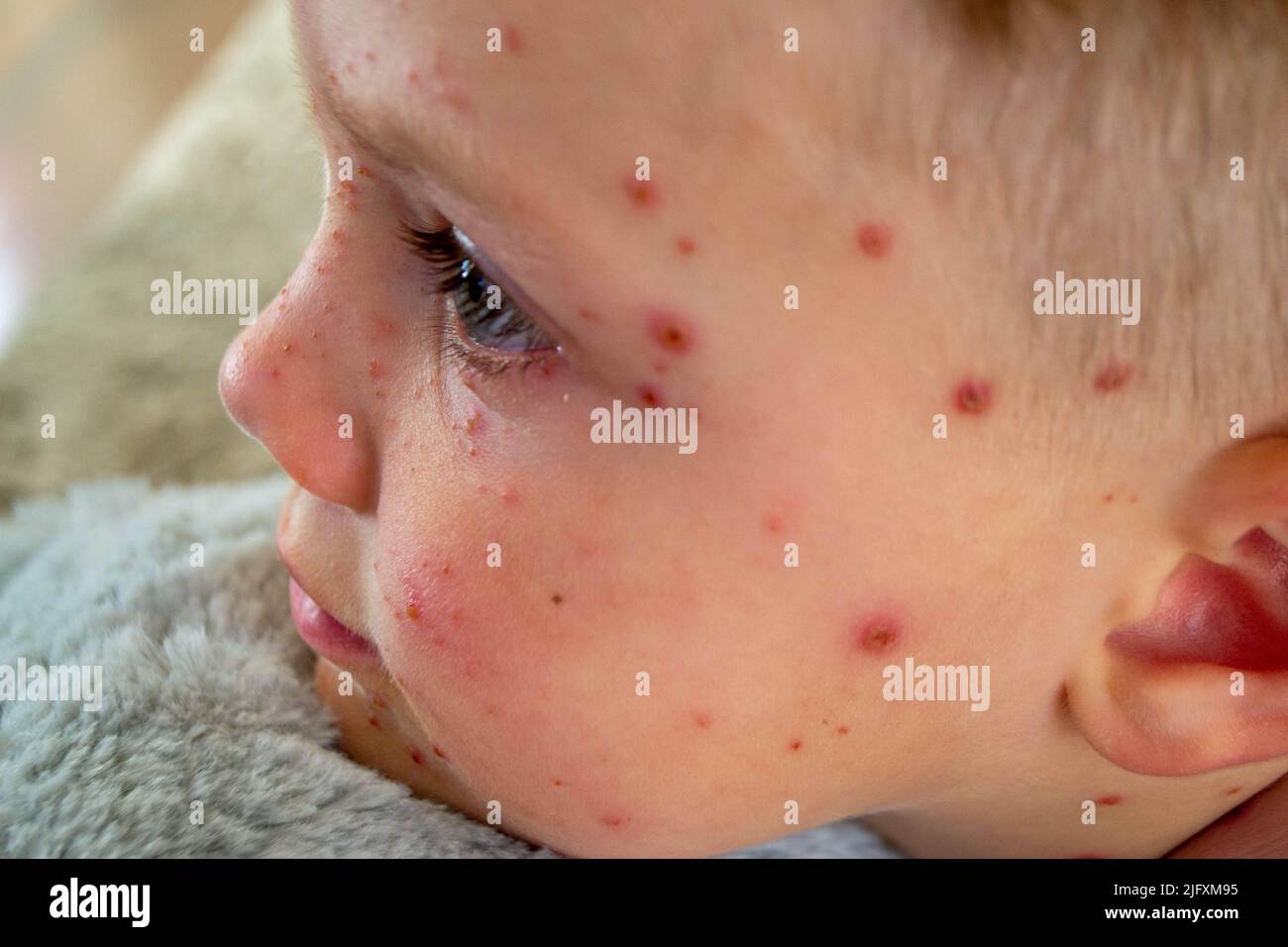 Smallpox vaccination boys hi-res stock photography and images - Alamy