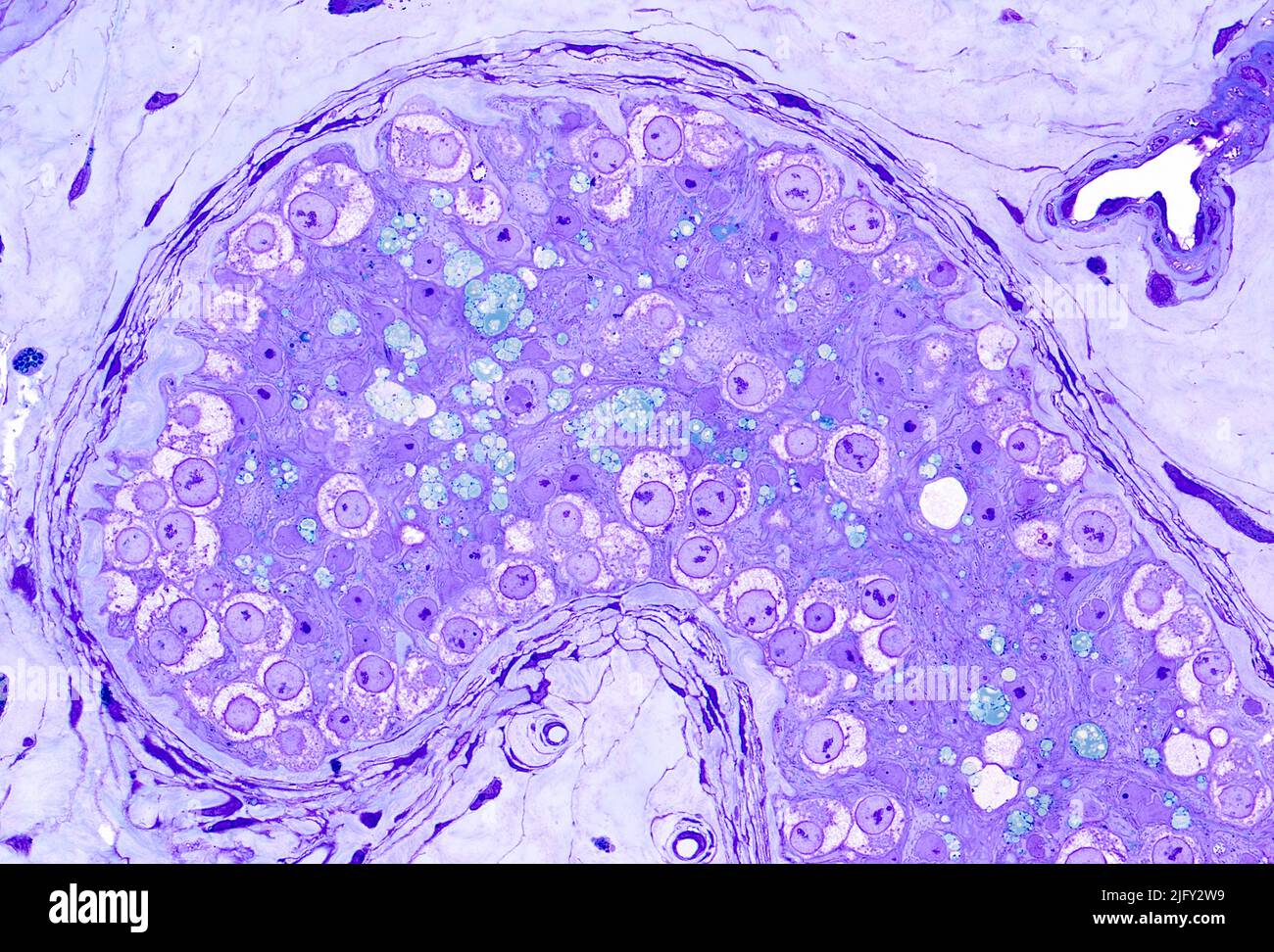Human testis neoplasia, light micrograph Stock Photo - Alamy