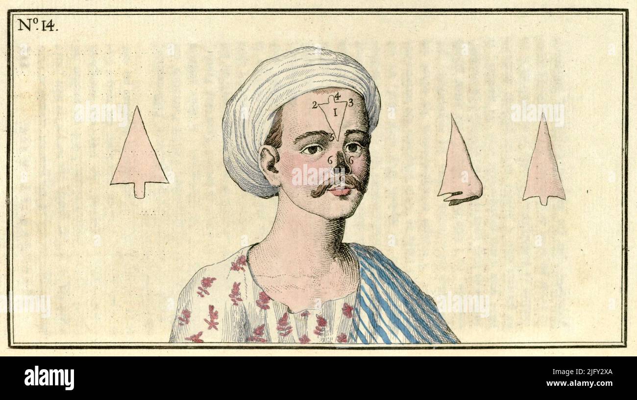 Nose surgery, 19th century illustration Stock Photo - Alamy