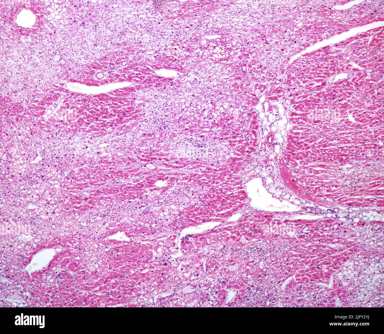 Acute myocardial infarction, light micrograph Stock Photo - Alamy