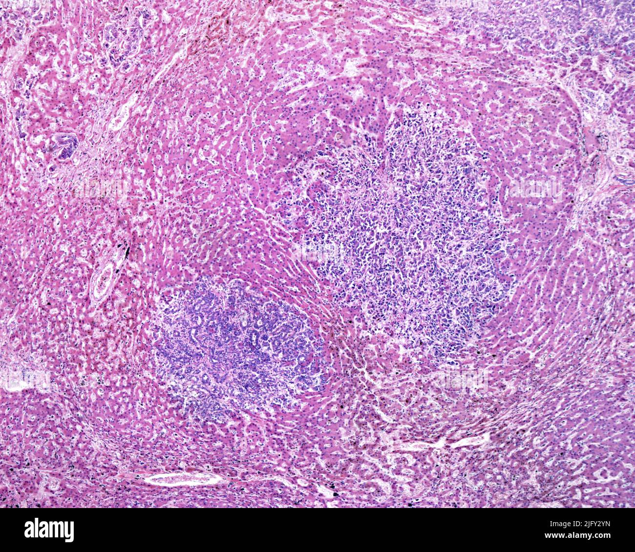 Human liver carcinoma, light micrograph Stock Photo - Alamy Human liver carcinoma, light micrograph Stock Photo - Alamy
