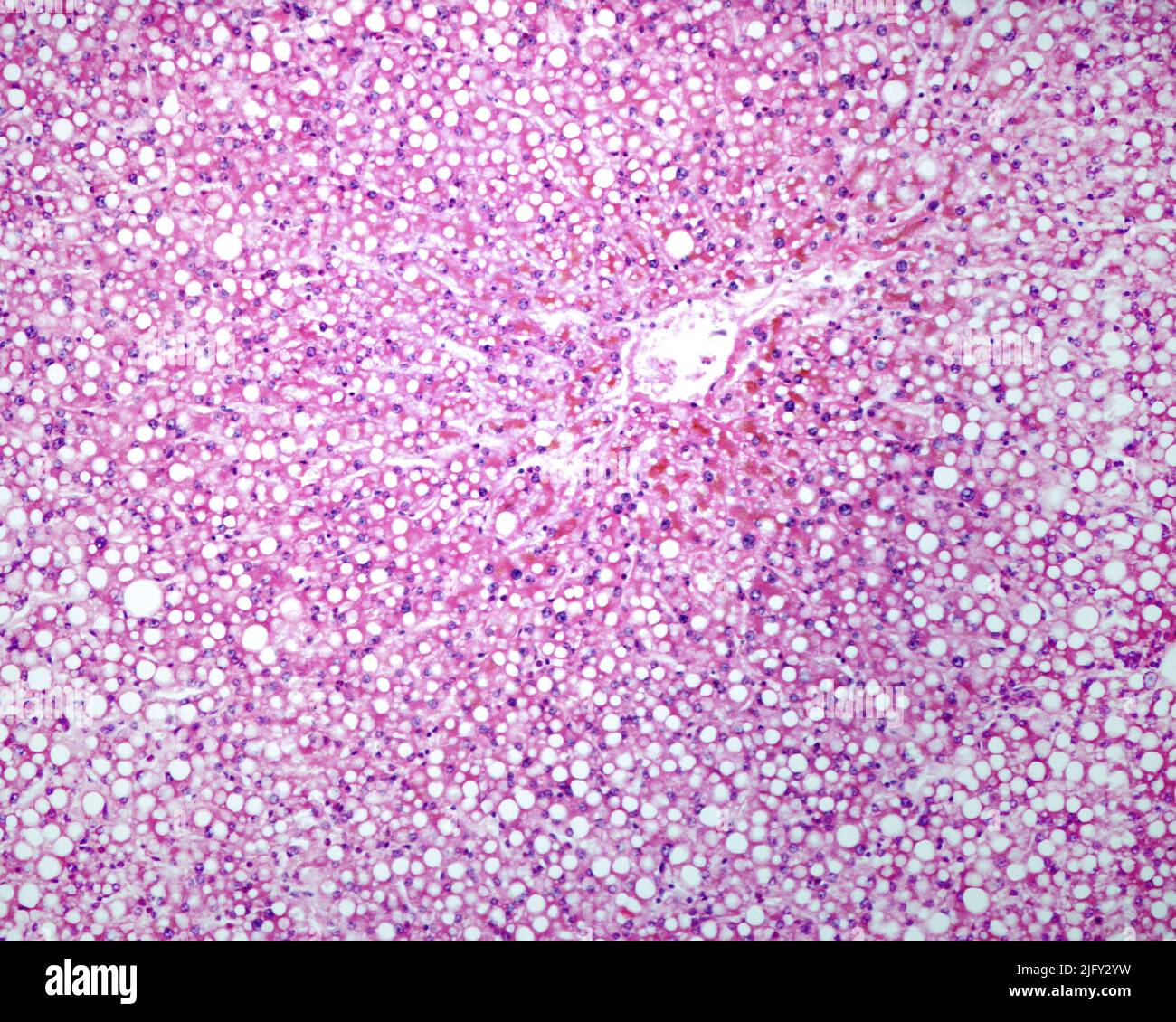 Human fatty liver, light micrograph Stock Photo - Alamy