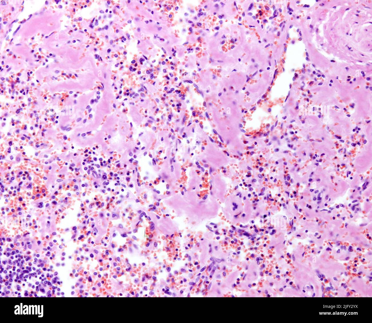 Amyloidosis, light micrograph Stock Photo - Alamy