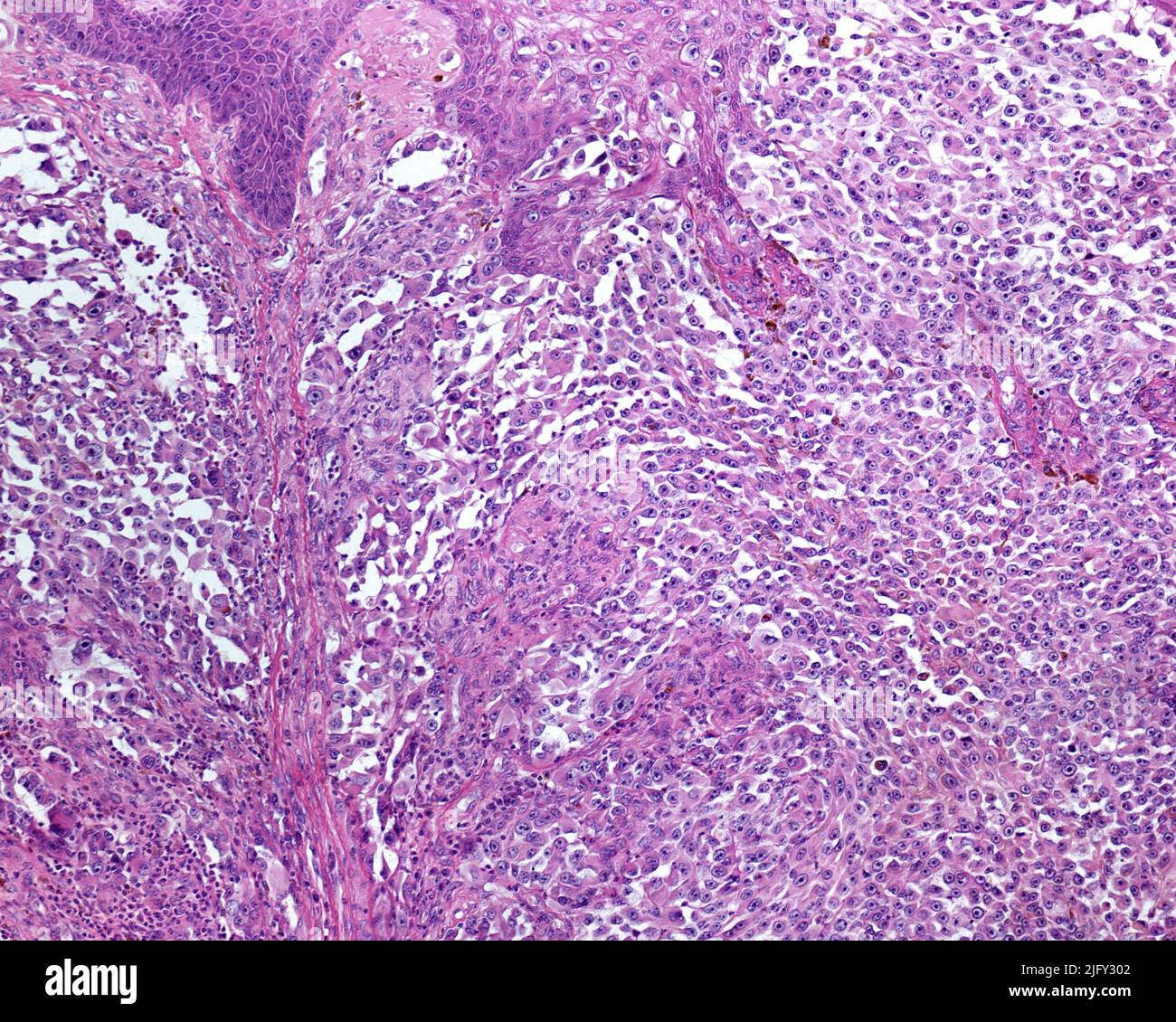 Malignant melanoma, light micrograph Stock Photo - Alamy