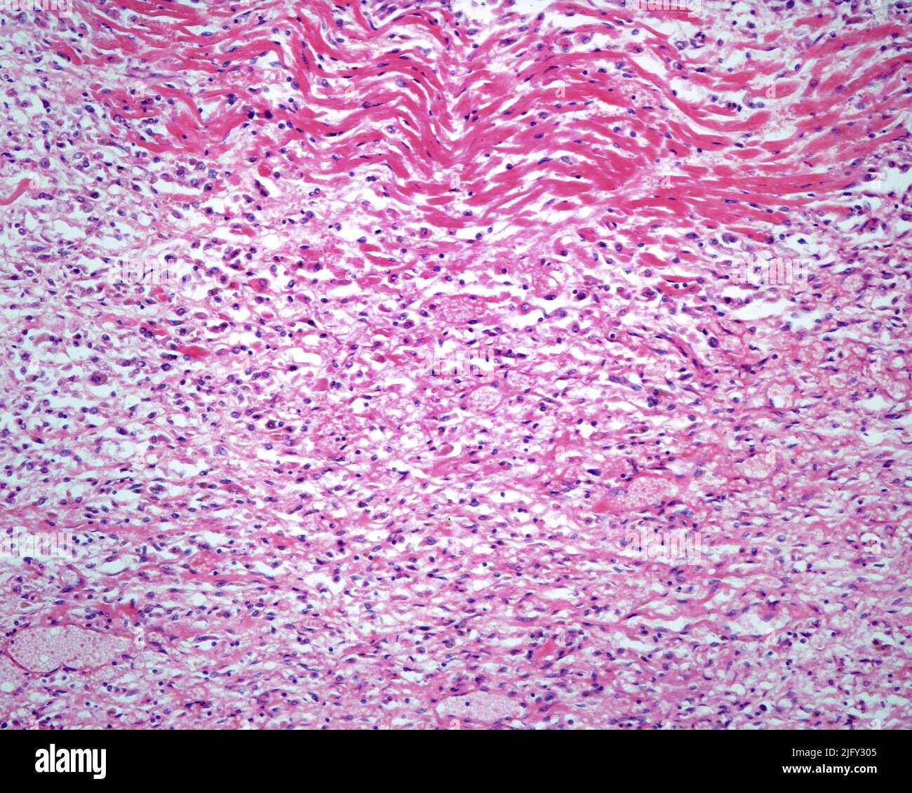 Acute myocardial infarction, light micrograph Stock Photo - Alamy