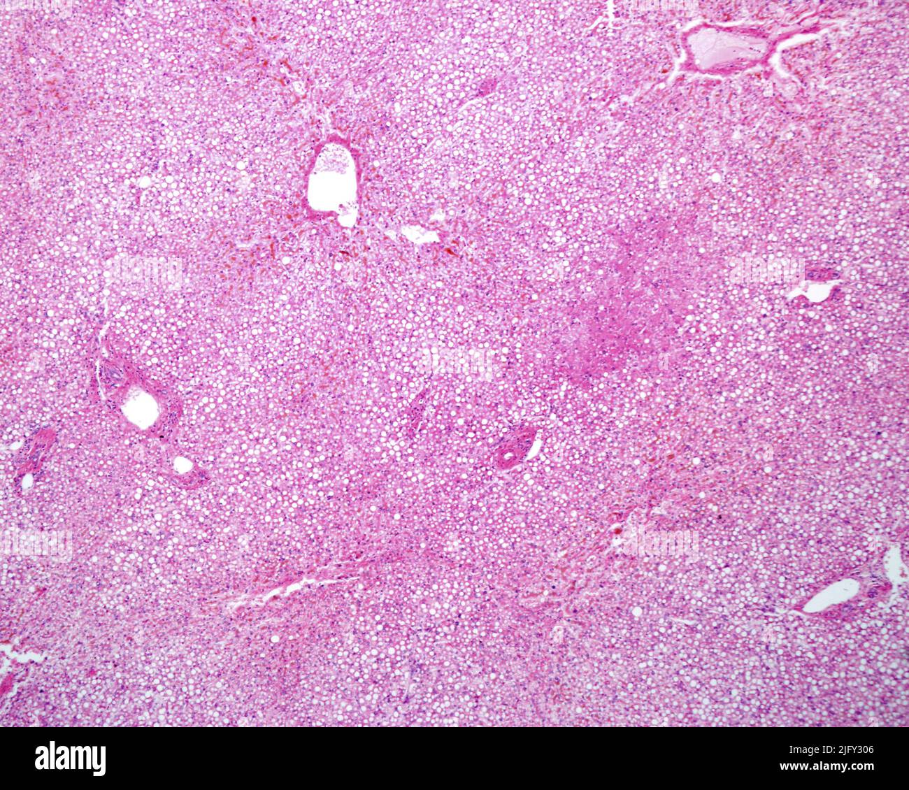 Human fatty liver, light micrograph Stock Photo - Alamy