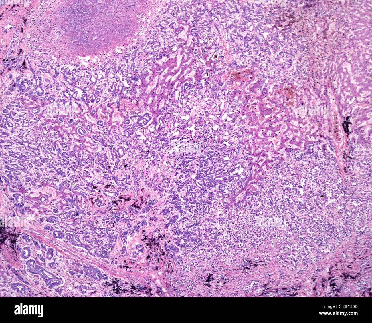 Human liver carcinoma, light micrograph Stock Photo - Alamy Human liver carcinoma, light micrograph Stock Photo - Alamy