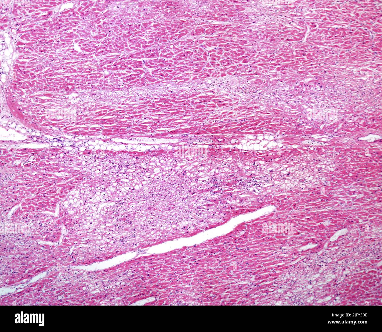 Acute myocardial infarction, light micrograph Stock Photo - Alamy