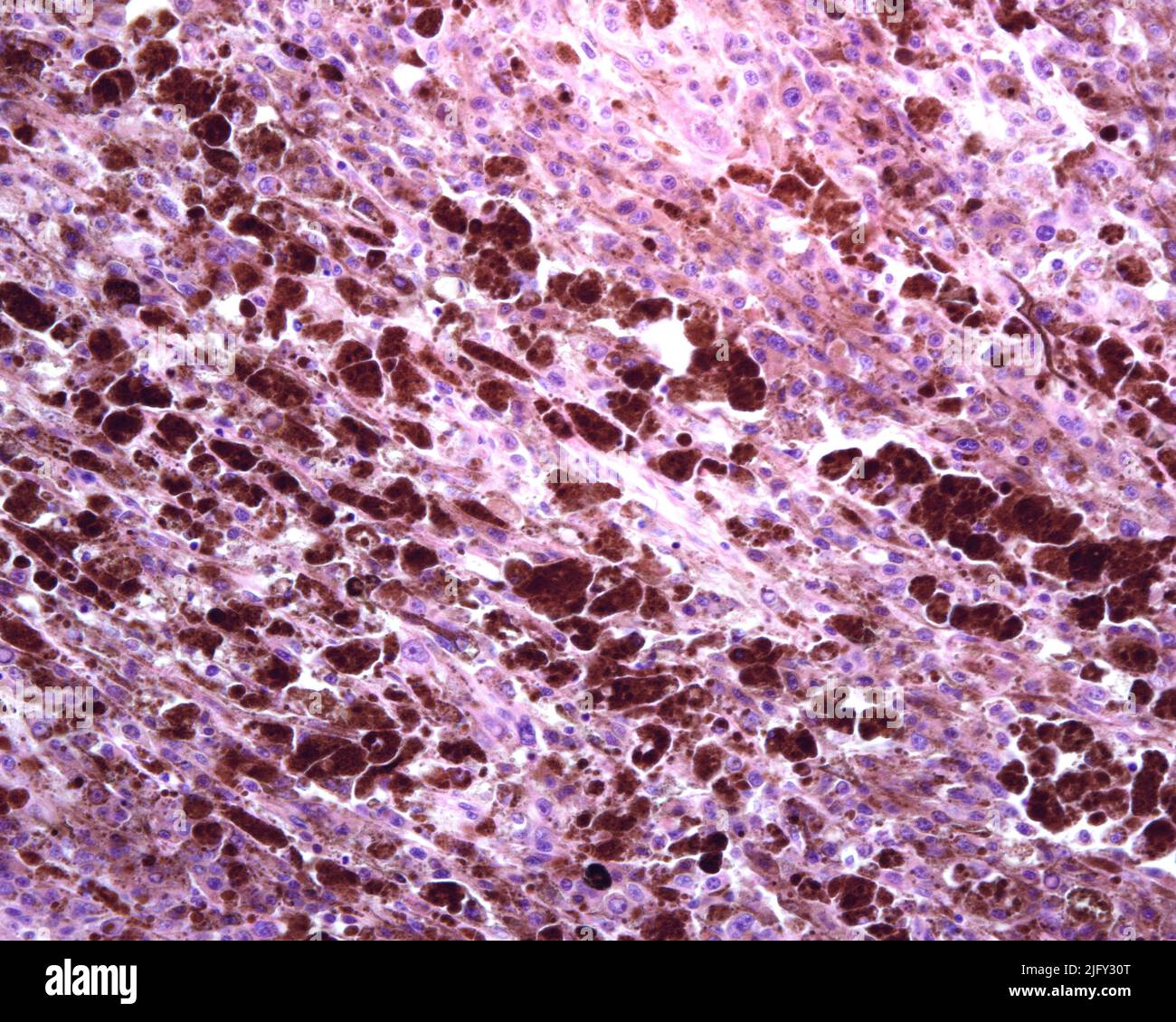 Metastasis of malignant melanoma, light micrograph Stock Photo - Alamy