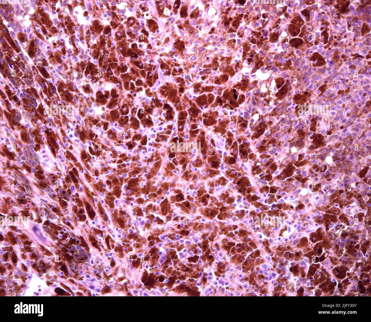 Metastasis of malignant melanoma, light micrograph Stock Photo - Alamy