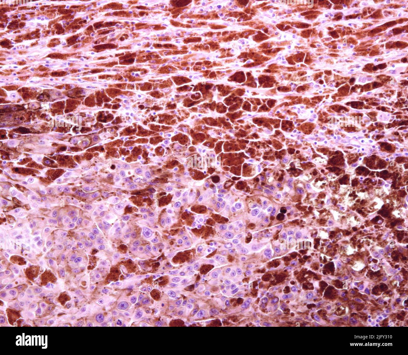 Metastasis of malignant melanoma, light micrograph Stock Photo - Alamy
