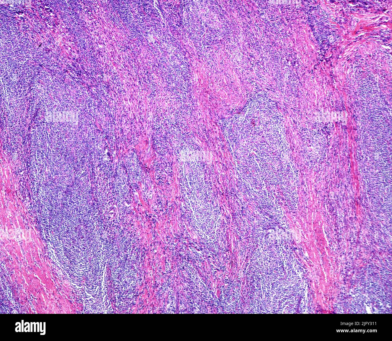 Reticulosarcoma of the stomach, light micrograph Stock Photo - Alamy