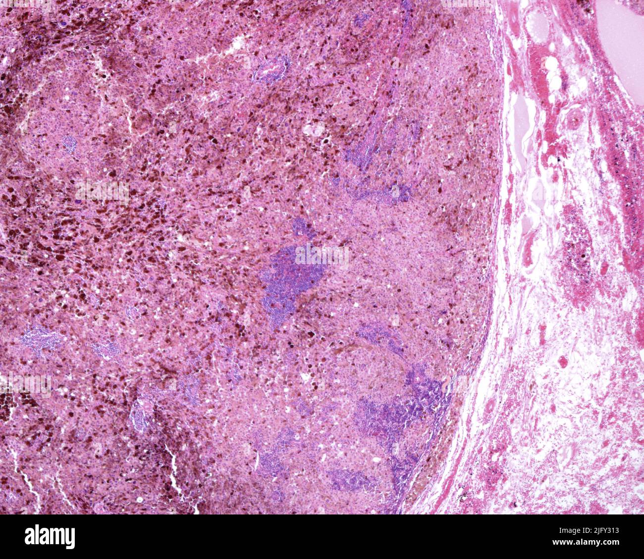 Metastasis of malignant melanoma, light micrograph Stock Photo - Alamy
