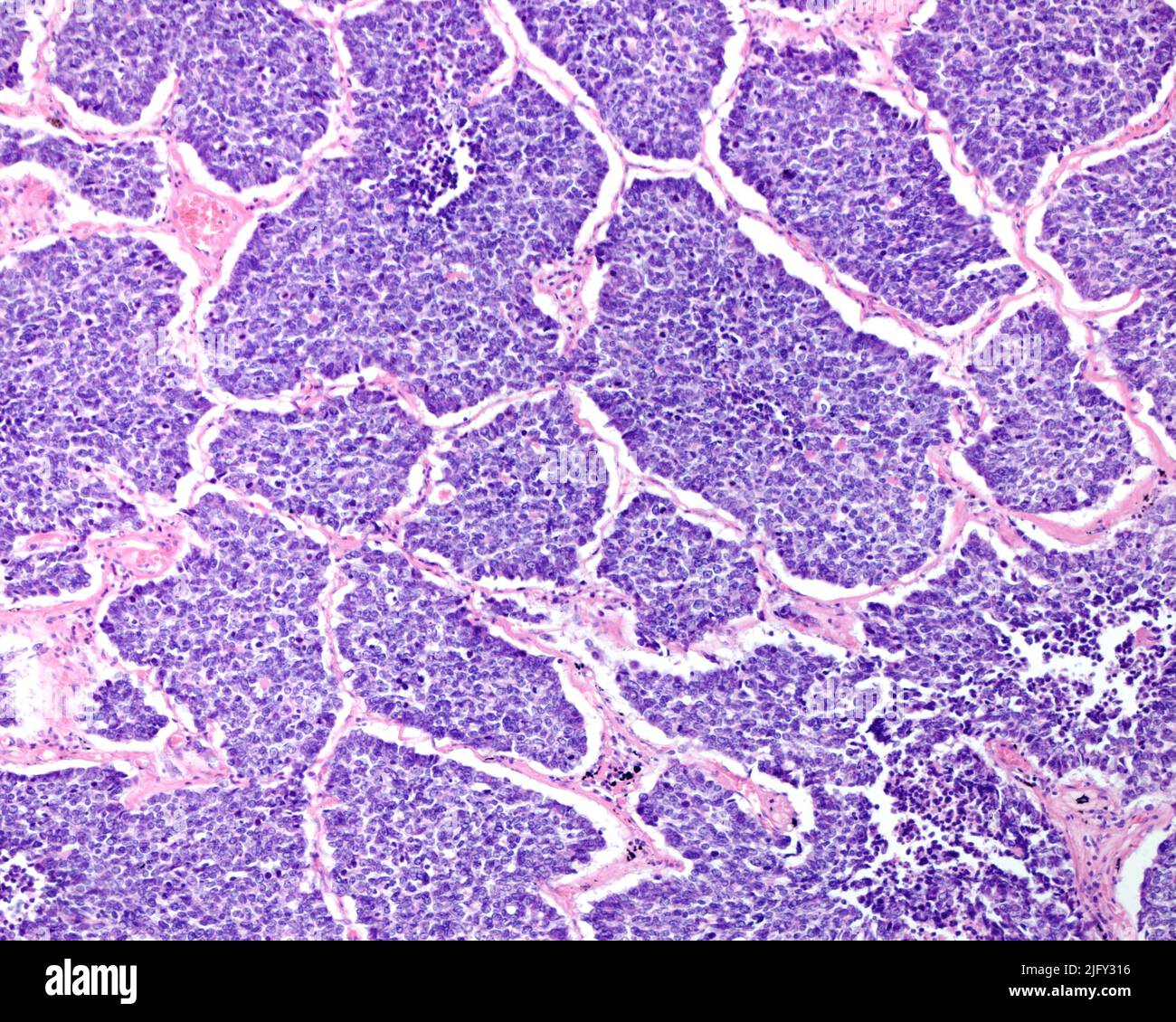 Small cell lung carcinoma, light micrograph Stock Photo - Alamy