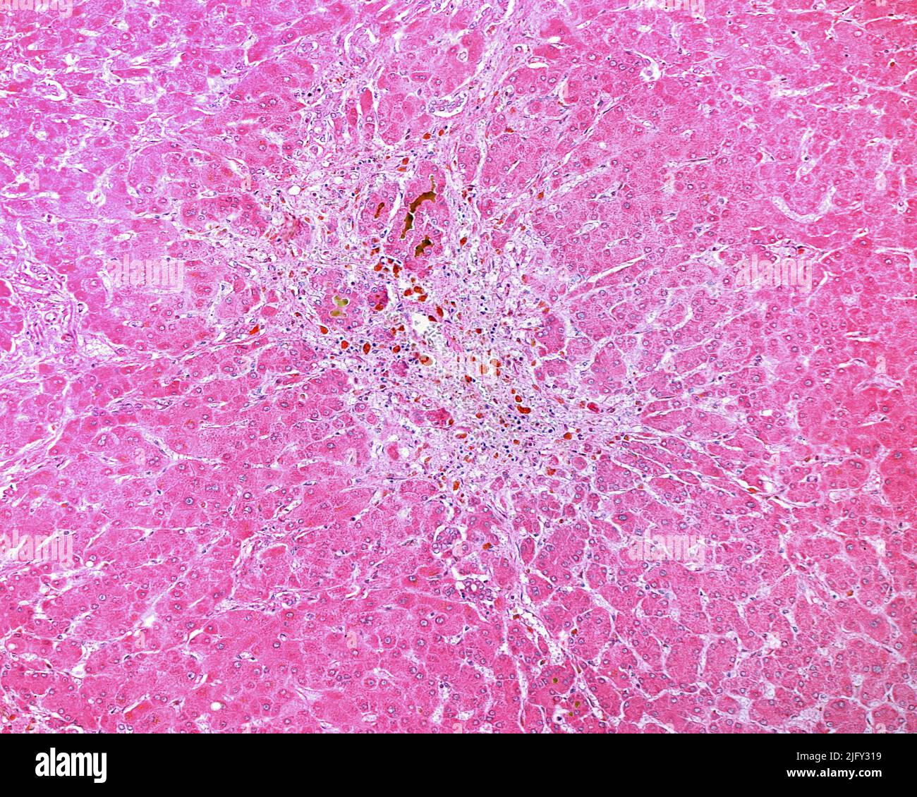 Toxic liver disease, light micrograph Stock Photo - Alamy