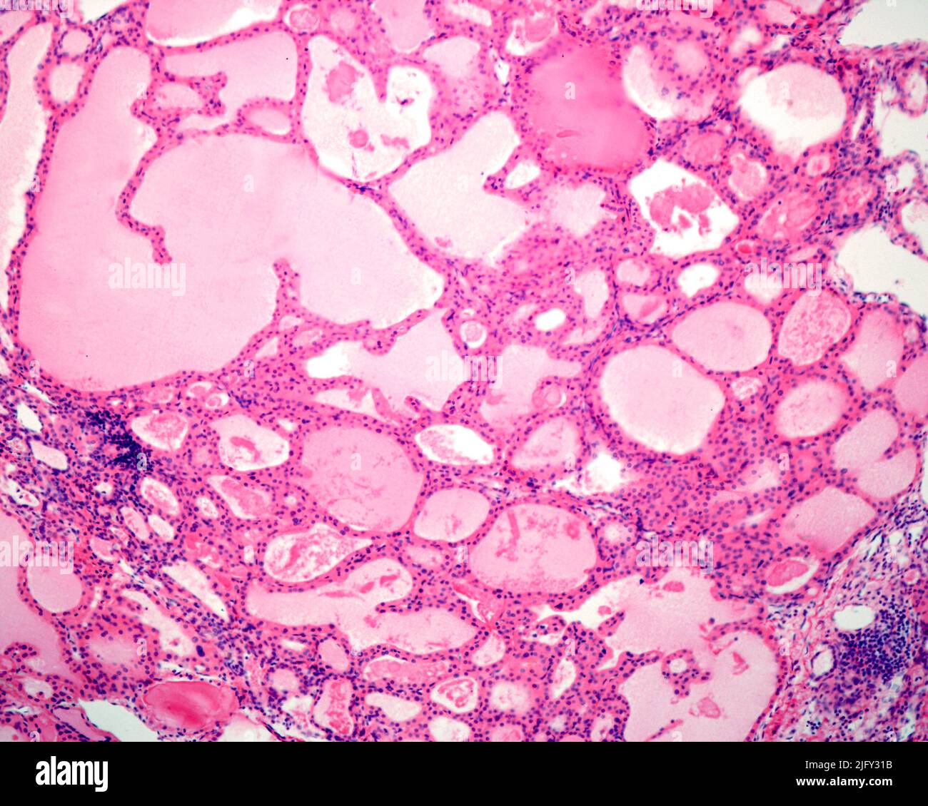 Adenomatous goitre, light micrograph Stock Photo - Alamy