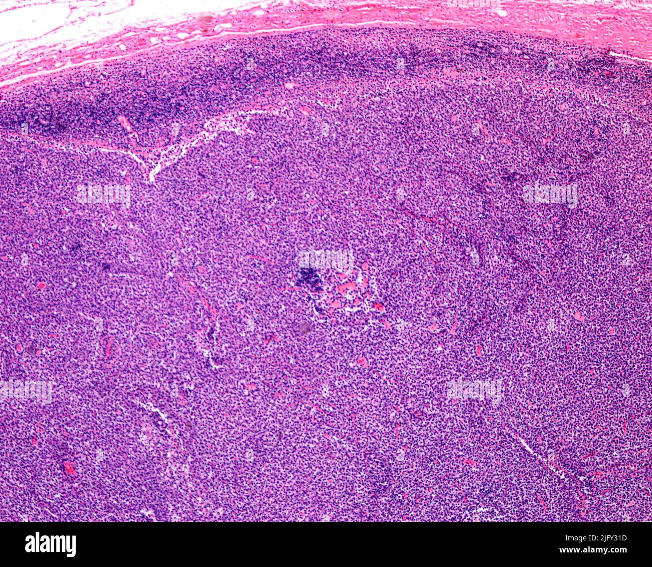 Reticulosarcoma of the lymph node, light micrograph Stock Photo - Alamy