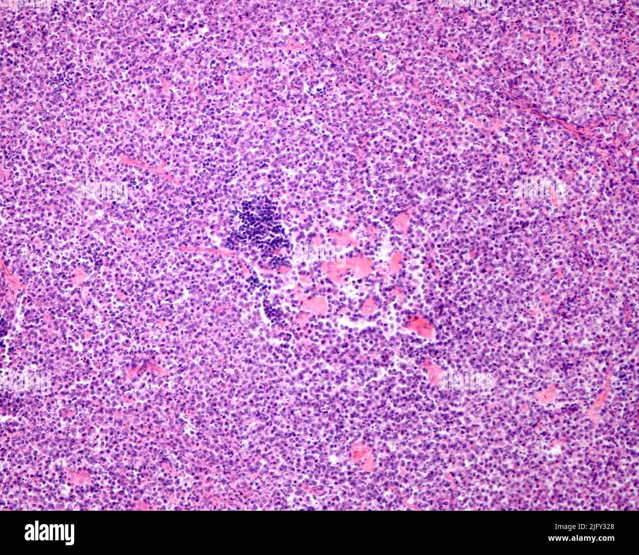 Reticulosarcoma of the lymph node, light micrograph Stock Photo - Alamy