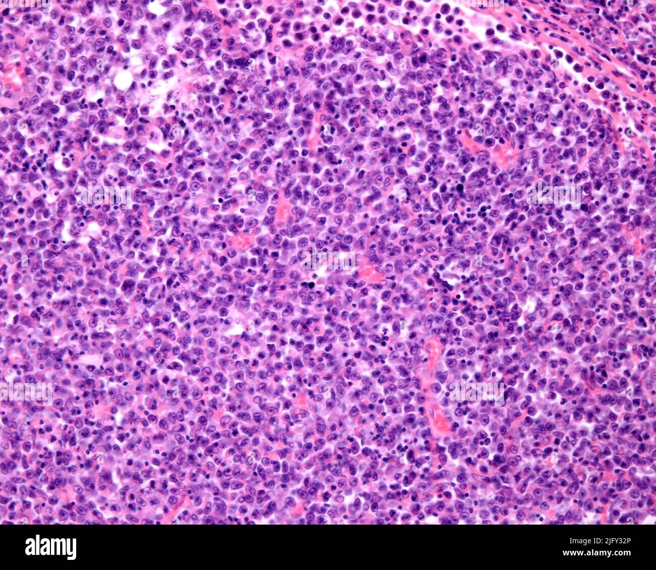 Reticulosarcoma of the lymph node, light micrograph Stock Photo - Alamy