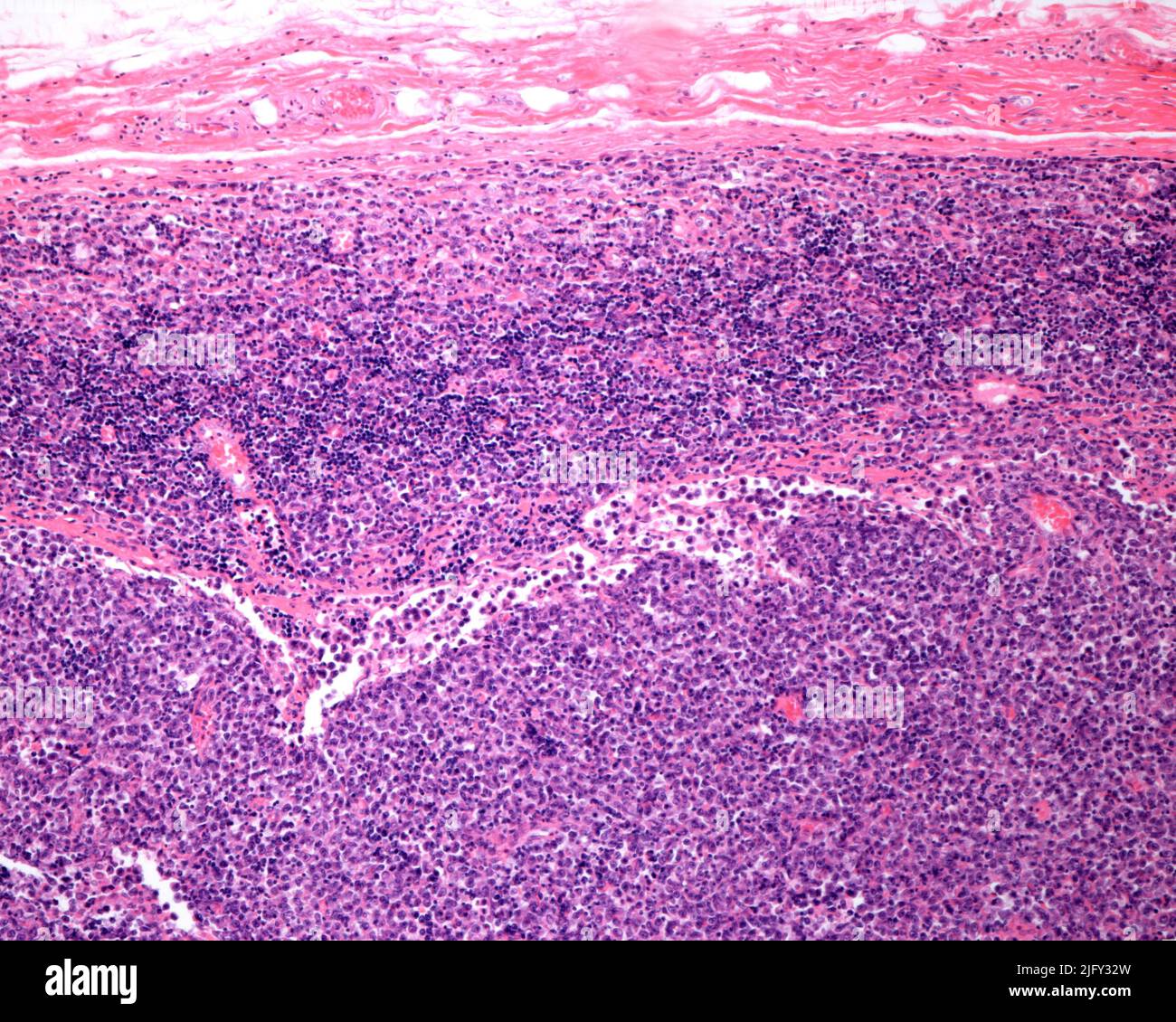 Reticulosarcoma of the lymph node, light micrograph Stock Photo - Alamy