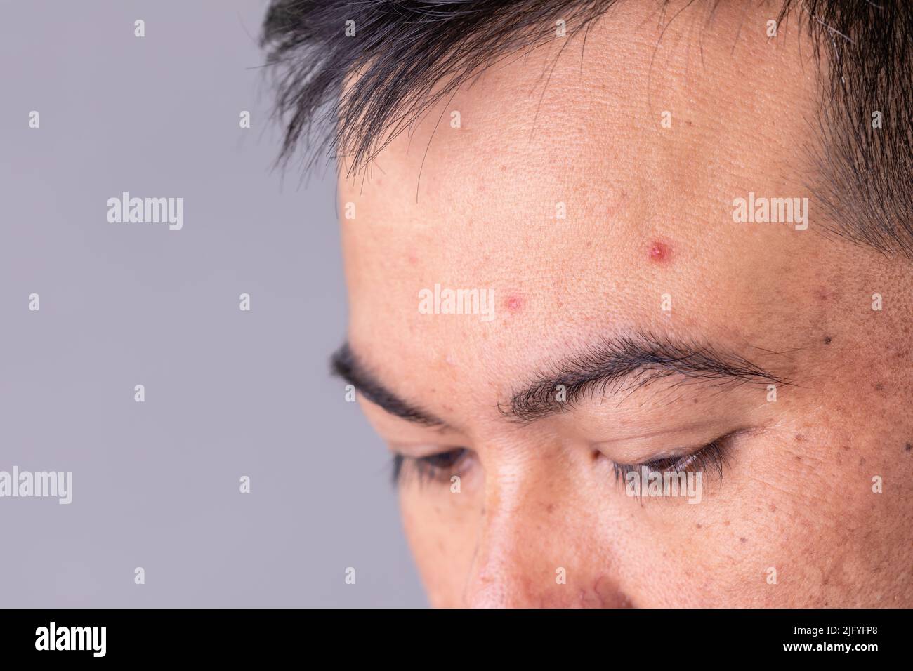 Macro face skin of asian man to show many skin problem. Men skin care ...