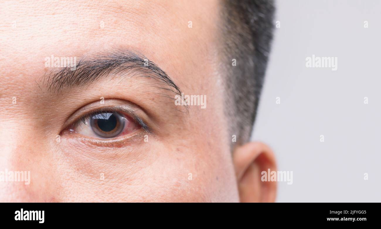Eye irritation concept : Macro red eye of man, conjunctivitis eye or ...