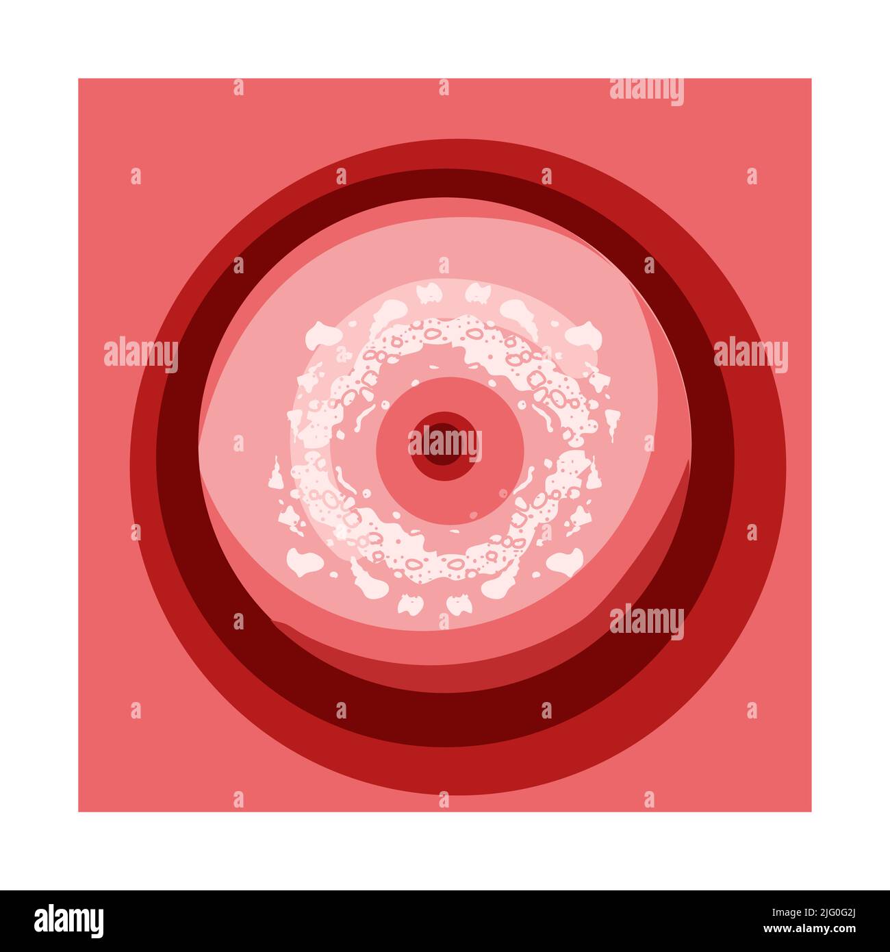 Cervical cancer Dysplasia CIN 1 stage infographic Female reproductive ...