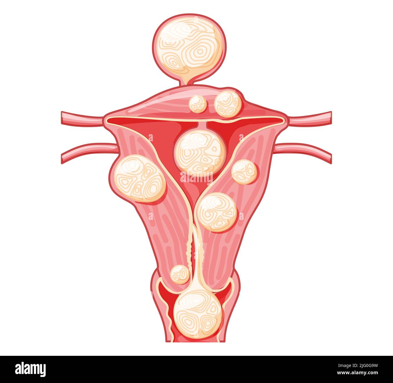 Set Of Uterine Fibroids Female Leiomyomas Reproductive System Uterus In