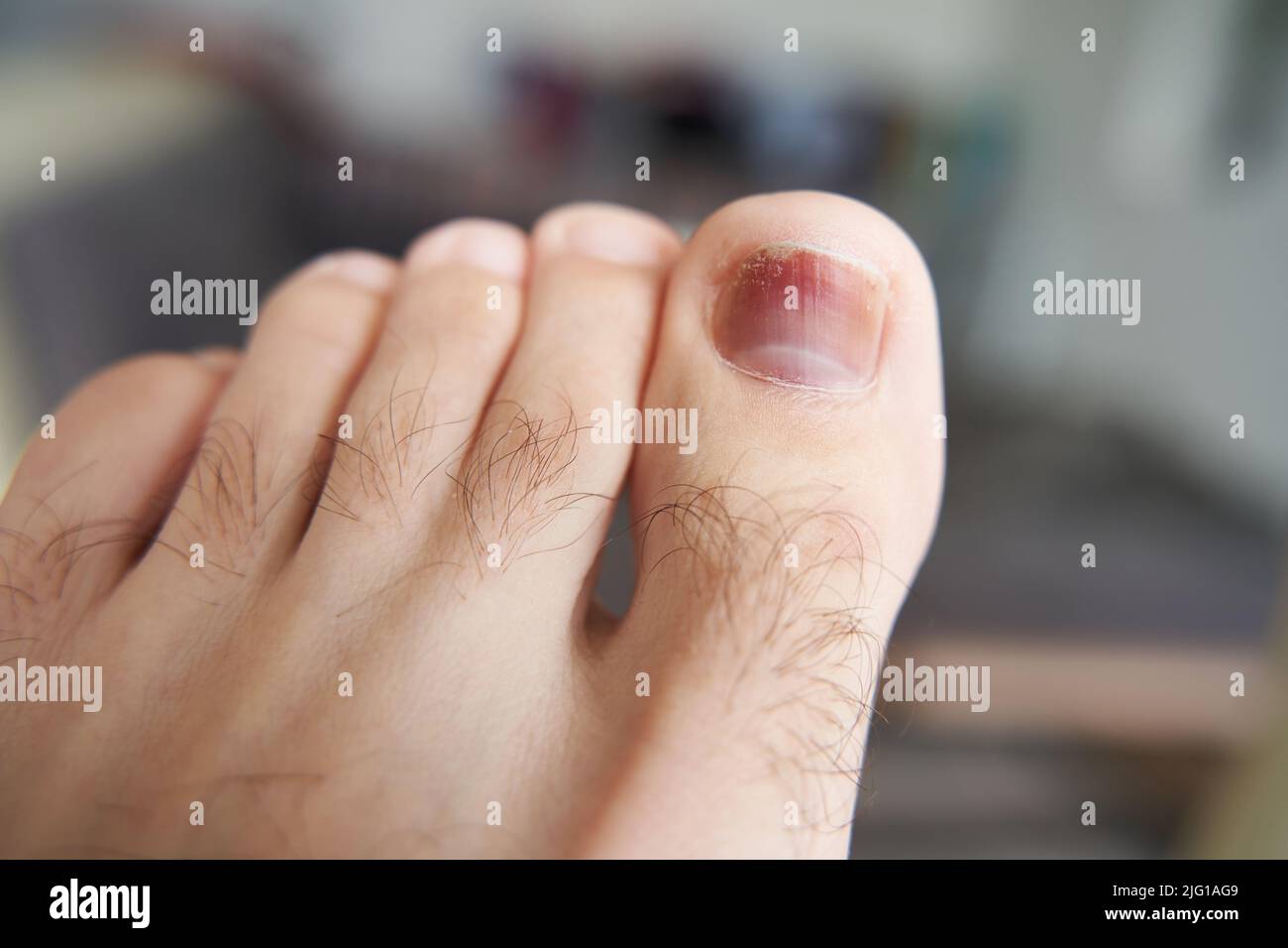 A toe is injured, a heavy object has fallen on the finger. Hematoma ...