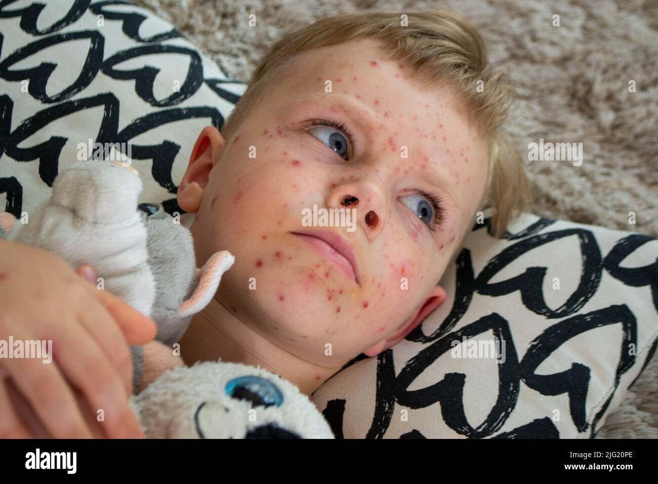 Smallpox vaccination boys hi-res stock photography and images - Alamy