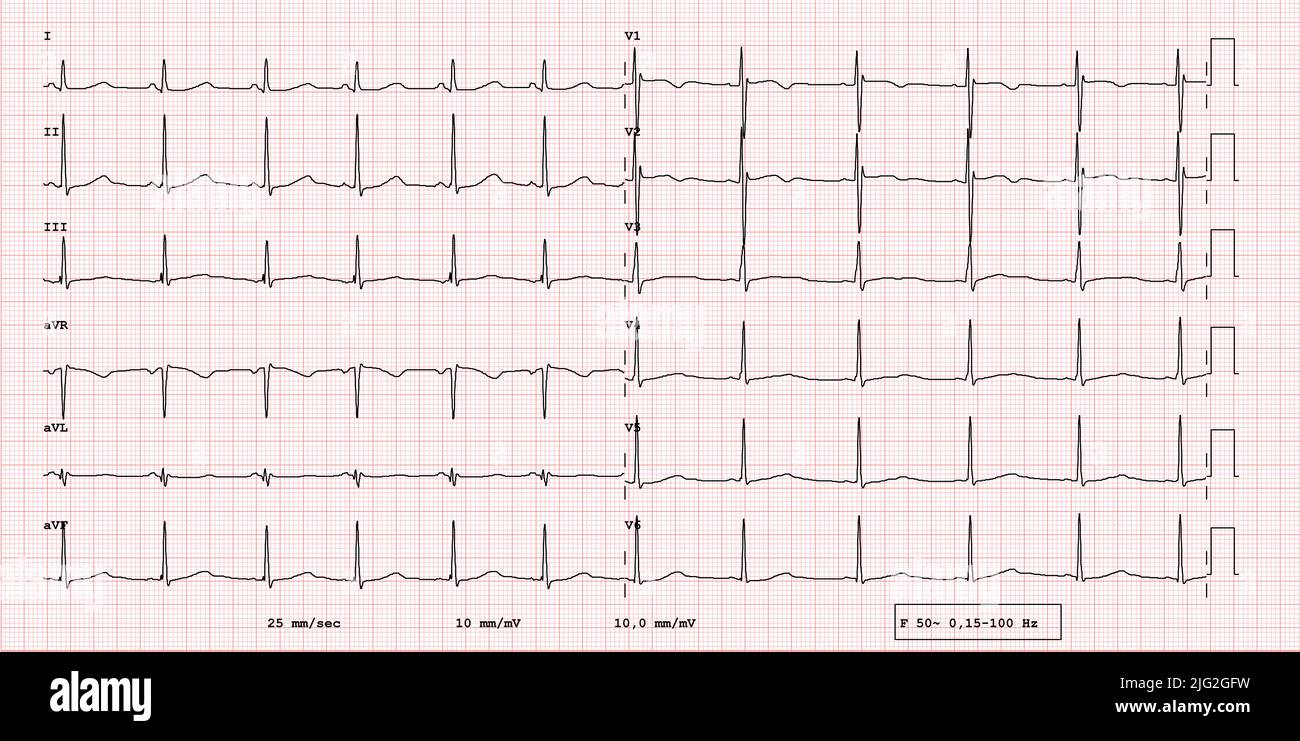 ECG example of a pathological 12-lead rhythm. Long QT syndrome, real ...
