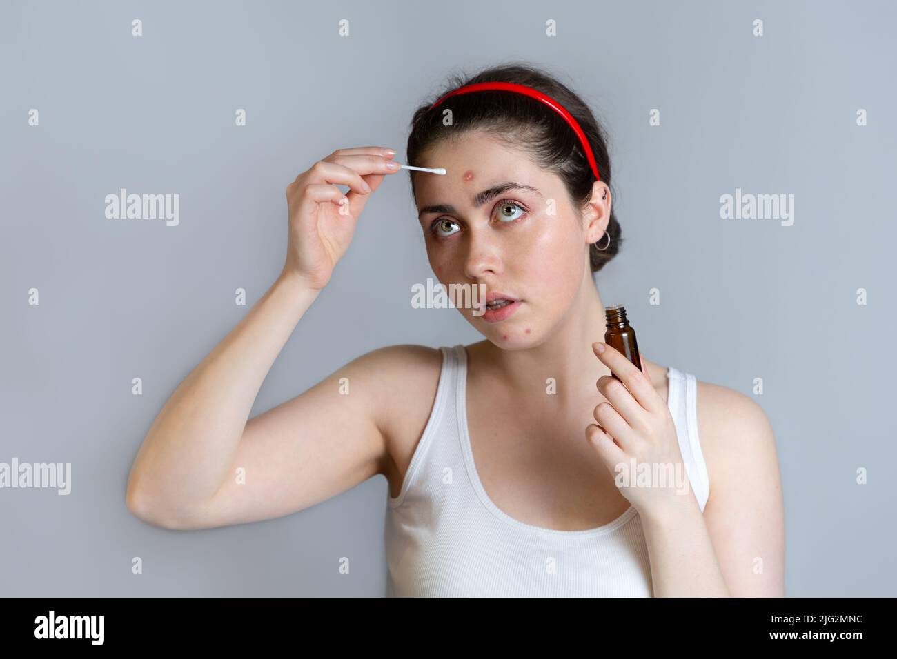 A beautiful young woman with acne on the face, apply on the pimples ...
