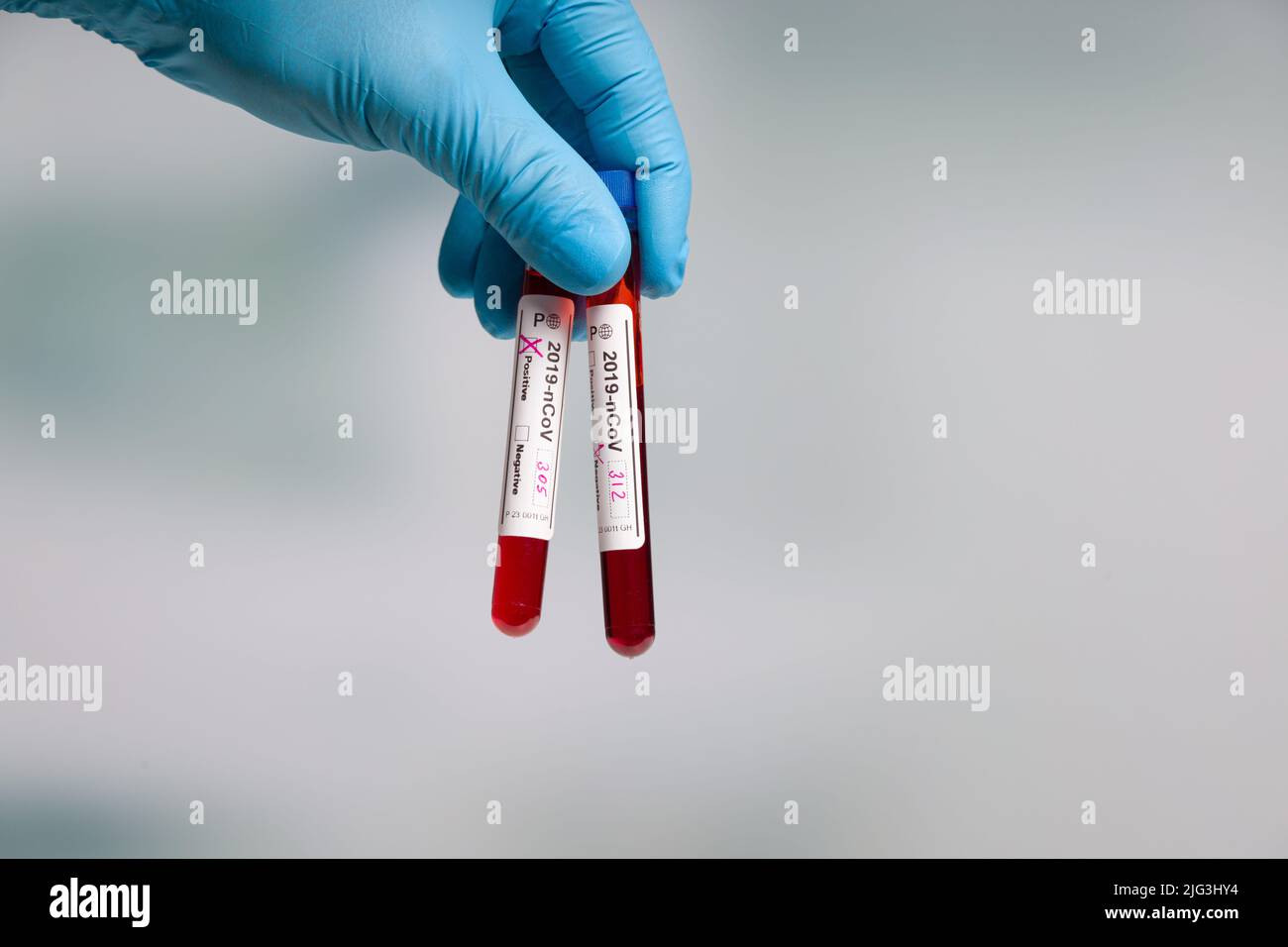 hand in medical gloves handling a blood probe with covid markers Stock ...