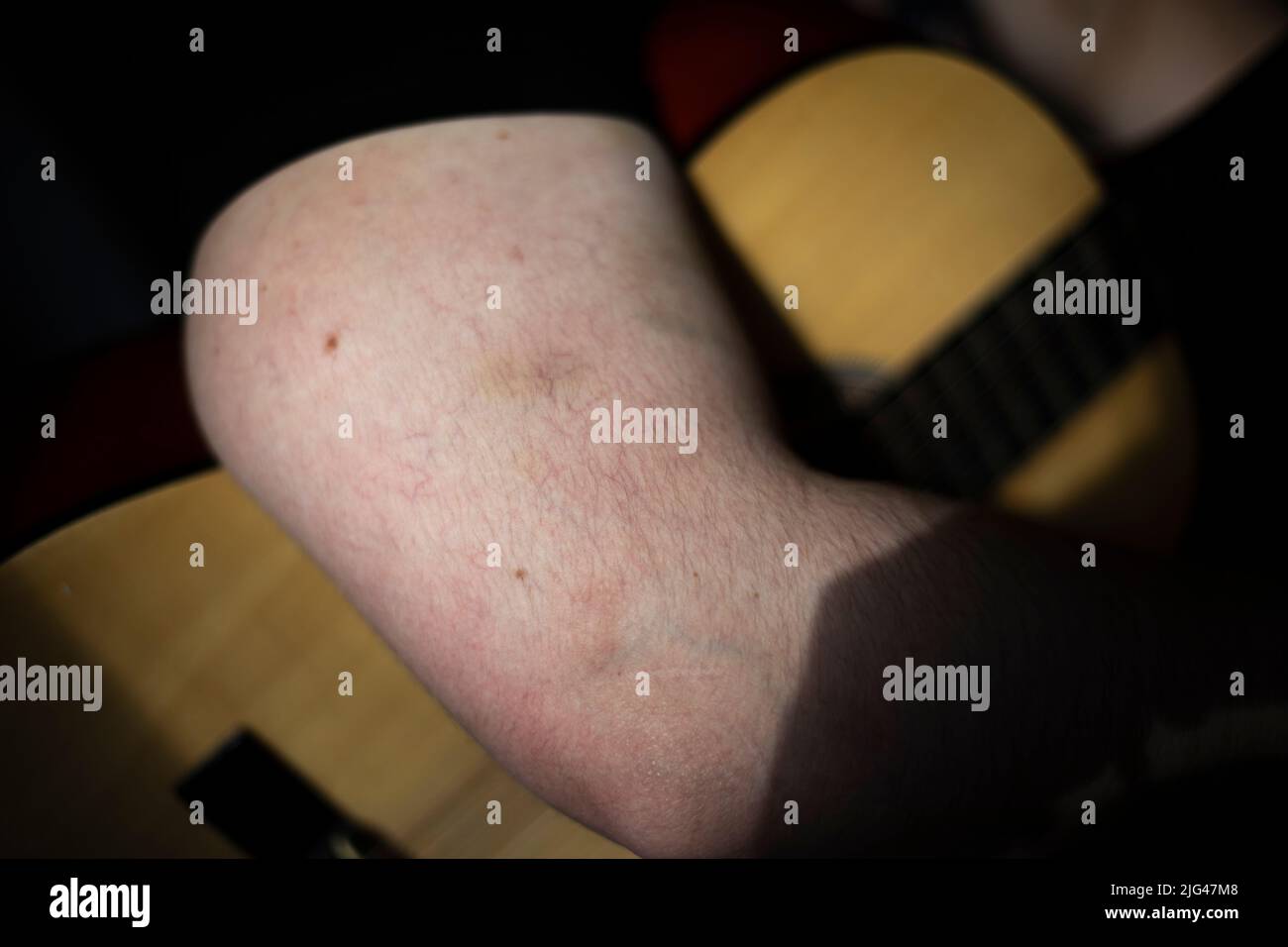 Bruise arm hi-res stock photography and images - Alamy