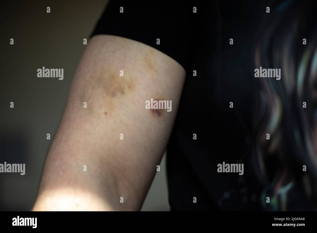 Bruise on man's arm. Place of impact. Shoulder injury. Body details ...