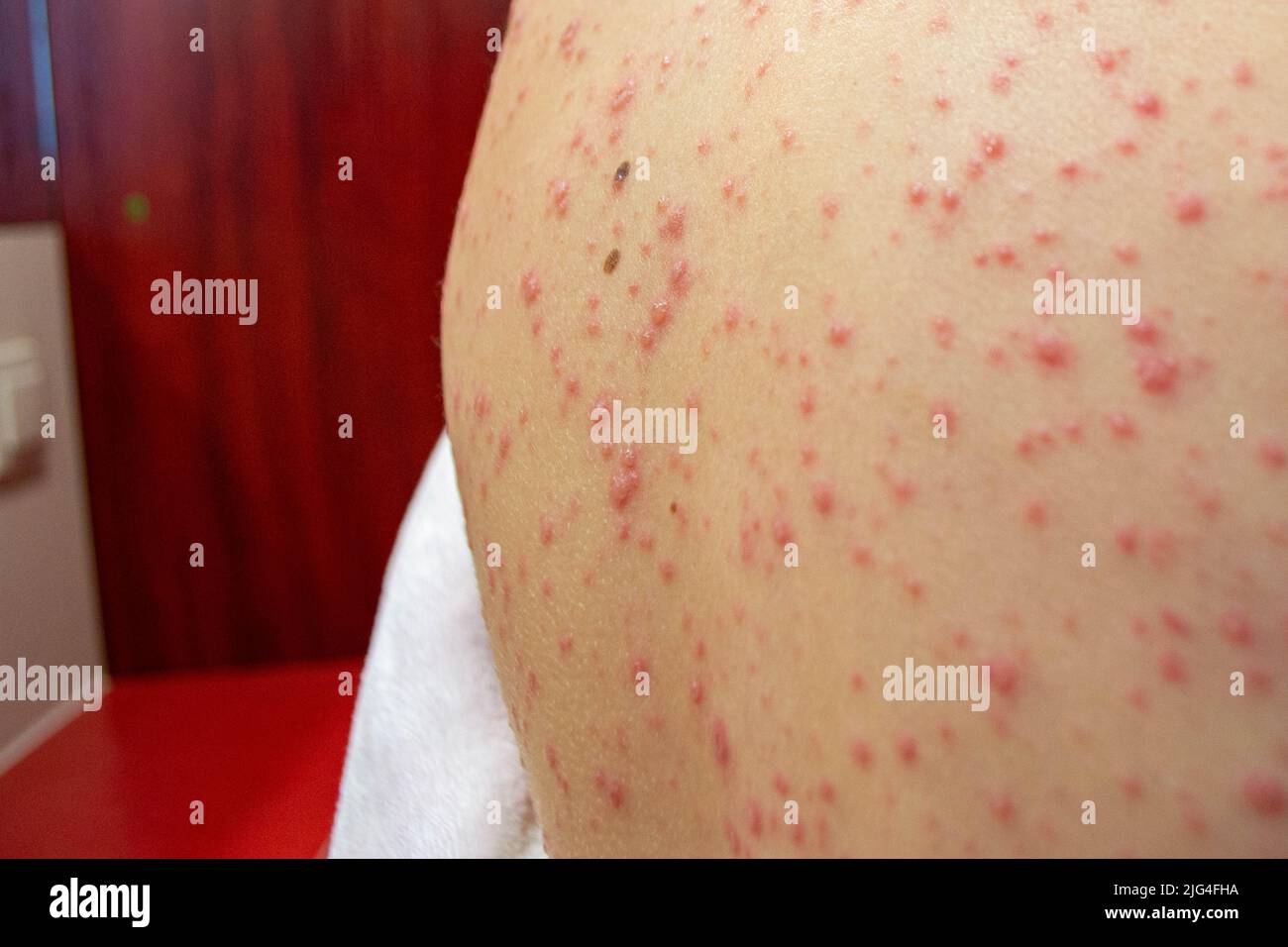 Varicella virus or Chickenpox bubble rash on child Stock Photo - Alamy