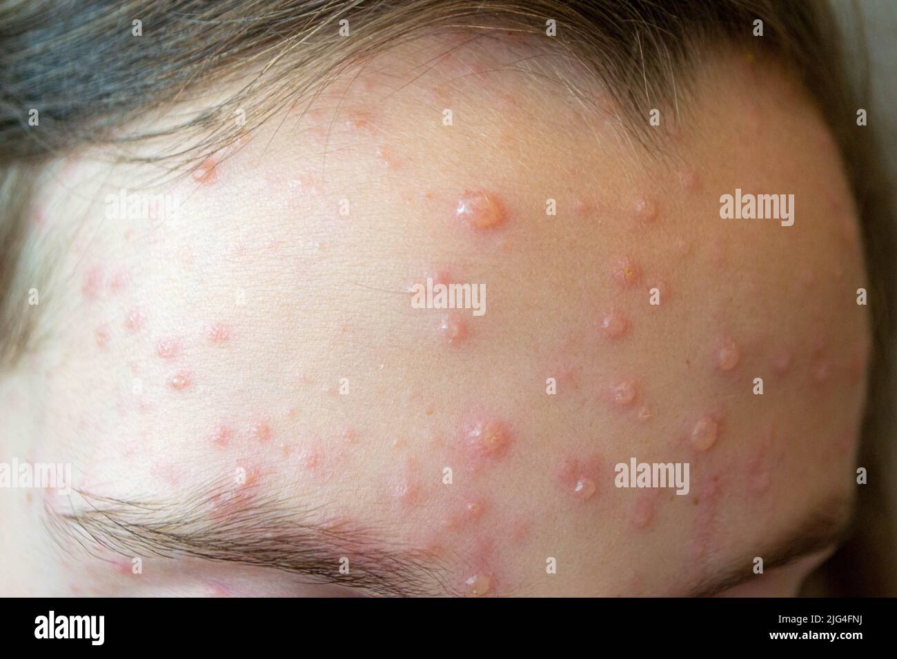 Varicella virus or Chickenpox bubble rash on child Stock Photo - Alamy