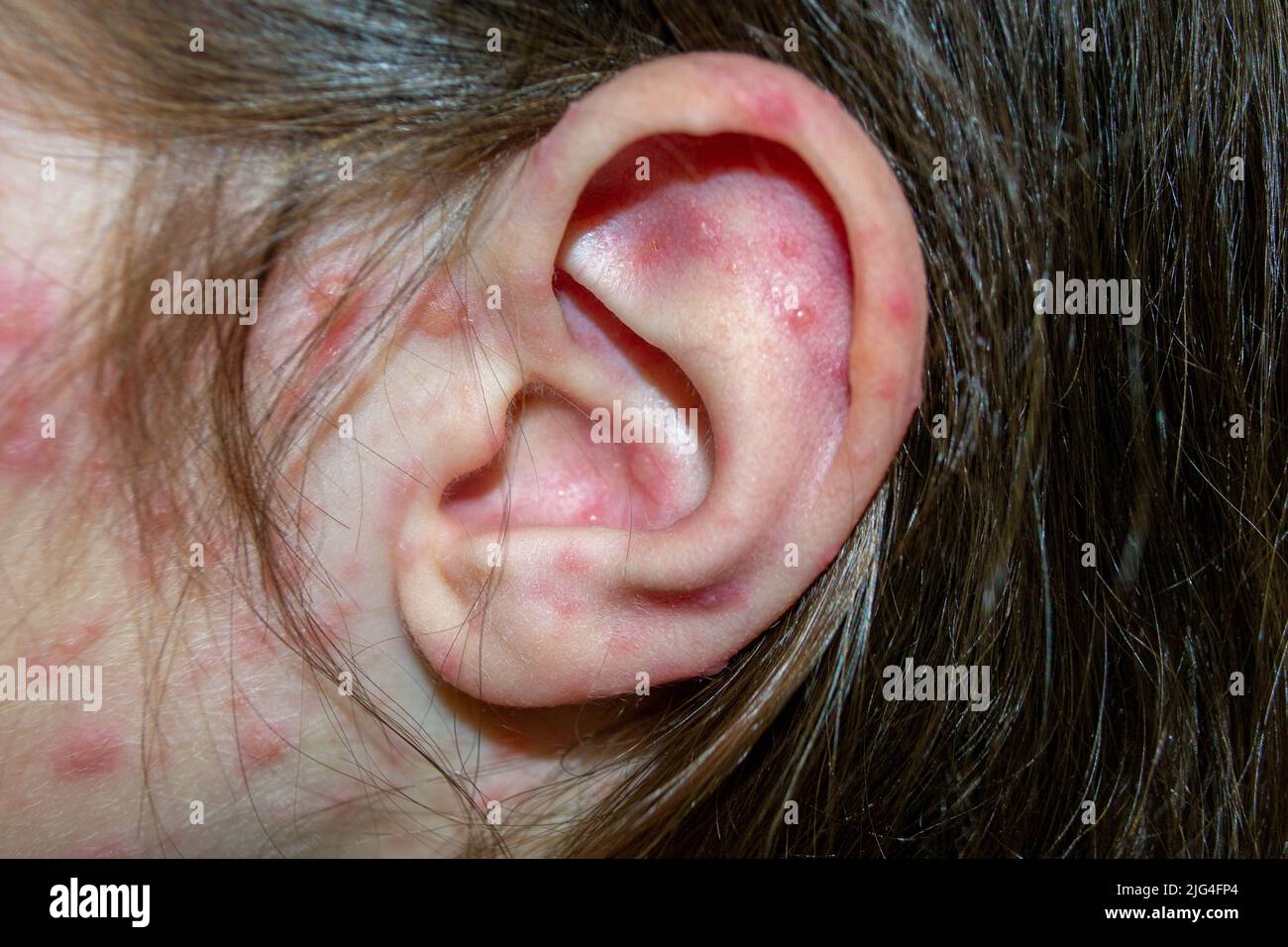 Varicella virus or Chickenpox bubble rash on child Stock Photo - Alamy