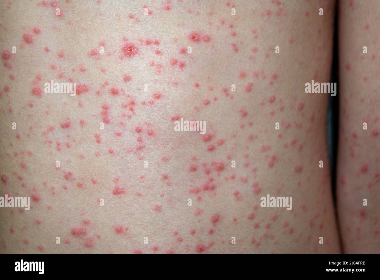 Varicella virus or Chickenpox bubble rash on child Stock Photo - Alamy