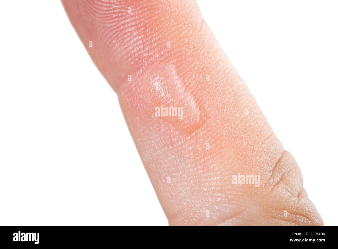 On hand finger there is blister callus or abscess. Medical trauma care ...